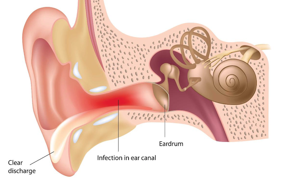 What Is Surfers Ear? Everything You Need to Know About Exostosis ...